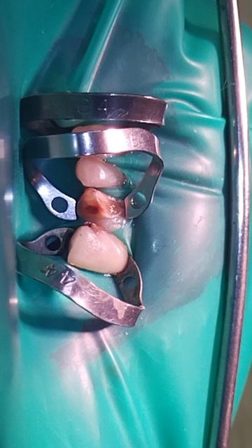 Абразивная отработка поверхности 41 зуба оксидом алюминия 30 мкм.