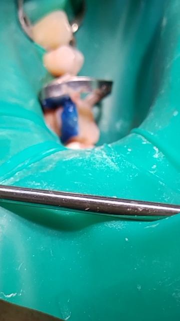 Подготовка поверхности зуба для обработки оксидом алюминия.