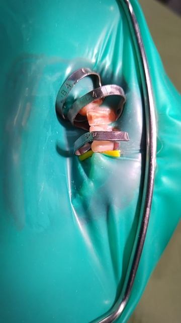 Раббердам изоляция с 41-33 зубы.