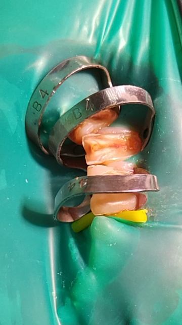 Раббердам изоляция 41-32 зубы.#раббердам#раббердамология