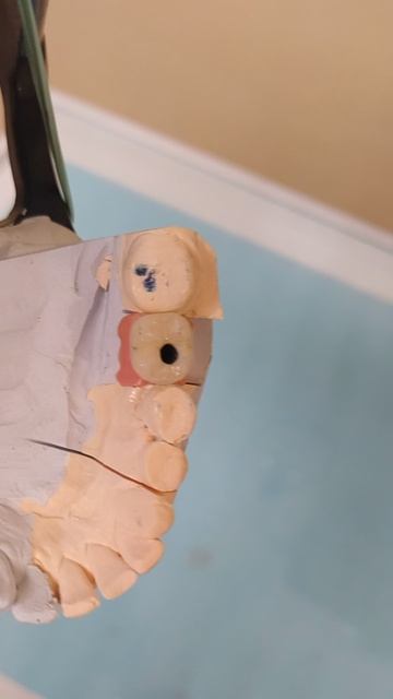 Металлокерамика на импланте 36.