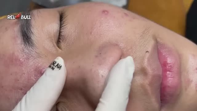 Выдавливание черных точек. Новое видео для расслабления. 𝟗𝟎𝟎𝟑𝟖 #черныеточки #чисткалица