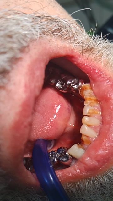 Вечный зуб на импланте.Perpentum tooth.