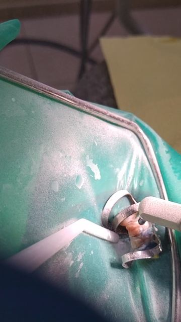 Абразивная отработка поверхности 31 зуба оксидом алюминия 30 мкм.