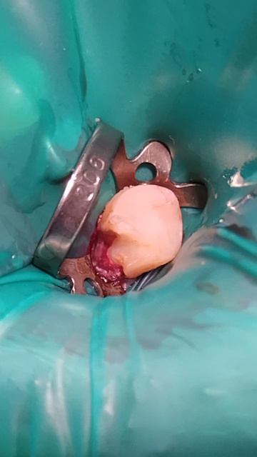 Одиночная раббердам изоляция 16 зуба.