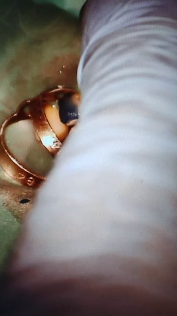 Абразивная отработка поверхности 11 21 зубов оксидом алюминия 30 мкм.