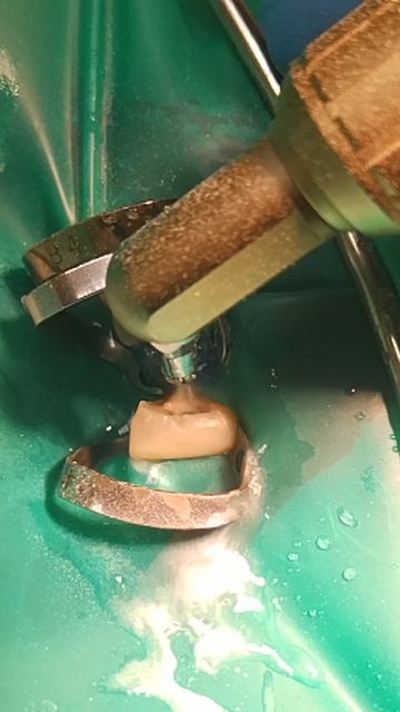 Абразивная отработка поверхности 42 зуба оксидом алюминия 30 мкм.