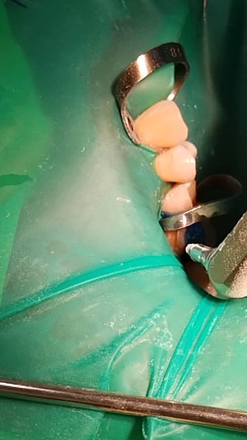 Абразивная отработка поверхности 14 зуба оксидом алюминия 30 мкм.