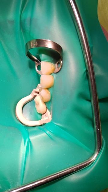 Раббердам изоляция 45-4 зубов.