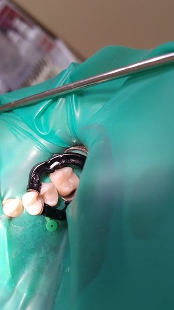 Раббердам изоляция 23-26 зубов.#раббердам#раббередамология