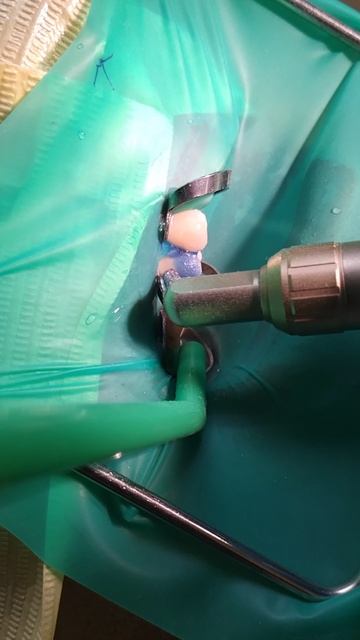 Абразивная отработка поверхности зуба 14.#abradivblastingtooth