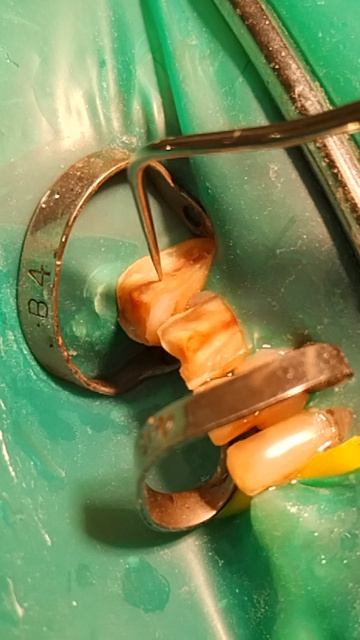 Качество абразивной обработке поверхности зуба оксидом алюминия.