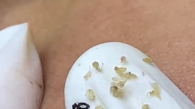 Relax Acne 014 • АСМР • Loan Nguyen collection