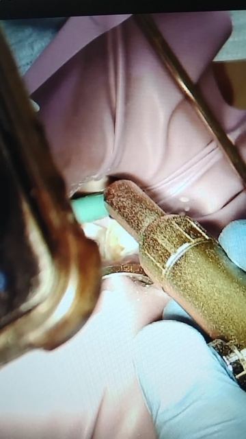 Абразивная отработка поверхности 37 зуба оксидом алюминия 30 мкм.