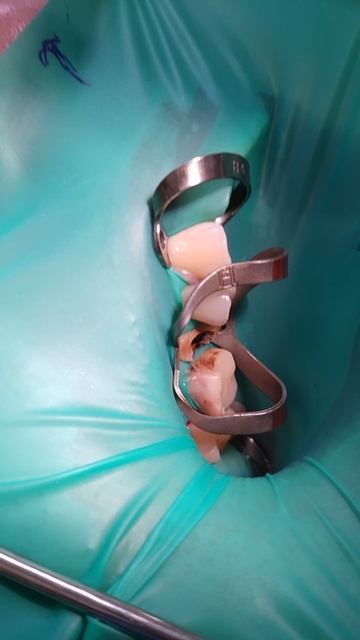 Раббердам изоляция 14-16 зубов.#раббердам#раббердамология