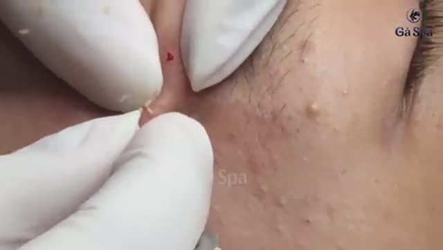 Удаление черных точек: новинка — Часть 1