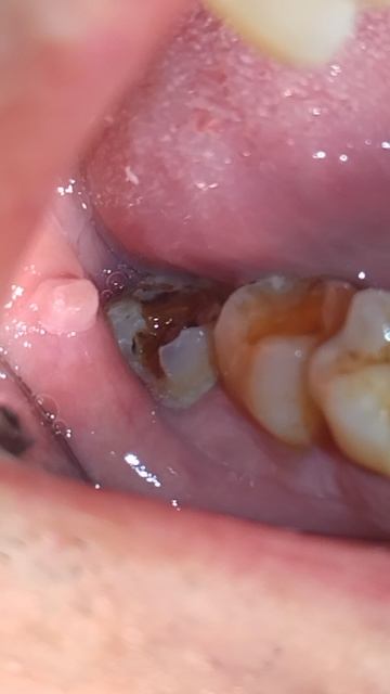 Хроническая травма (папиллома) слизистой щеки справа от острого края зуба.