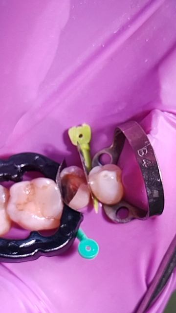 Установка матричного кольца Runa dent black.