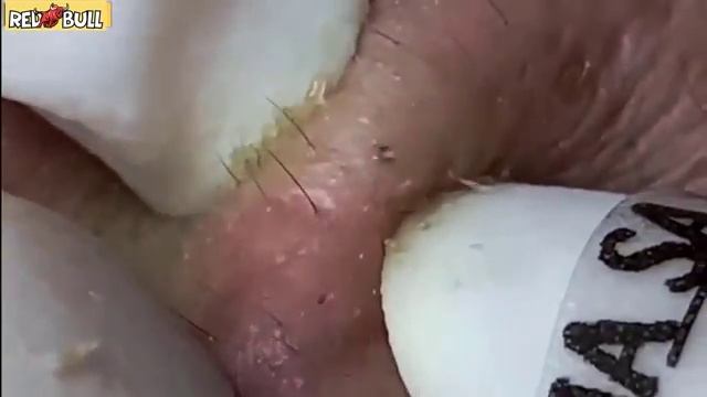 Удаление черных точек. асмр прыщи. Для расслабления. 𝟗𝟎𝟎𝟑𝟖𝟕 #черныеточки #чисткалица