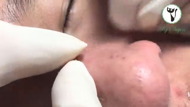 Лечение застарелых (зрелых) угрей на носу. #застарелыеугри #черныеточки #прыщинаносу