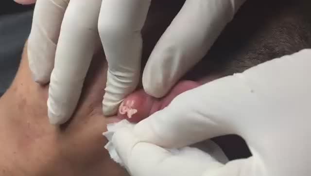 Лечение самых ужасных в мире кистозных угрей, «паразитирующих» на коже человека