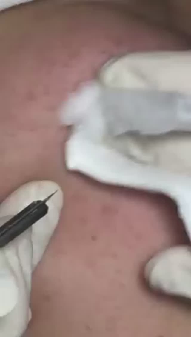 Лечение черных точек — Часть 1 #черныеточки #лечениеакне #проблемнаякожа