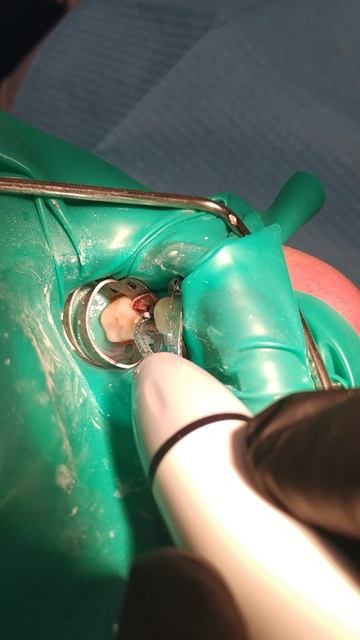 Извлечение титанового штифта из 36 зуба.Ультразвук.