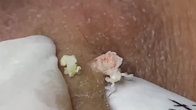 ASMR с подсветкой: чистка пор под увеличением. 2153  #комедоны #проблемнаякожа #уходзалицом