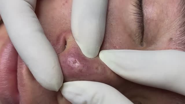 Relax Acne 006 • АСМР • Loan Nguyen collection