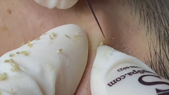 Удаление прыщей (акне) для мужчин #акне #постакне #механическаячистка