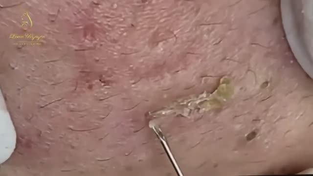 ASMR для сна: шепот и тихие звуки чистки. 2148 #черныеточки #чисткалица  #прыщи #угри