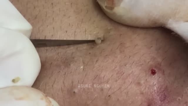 Потрясающее удаление воспаленных черных точек. Часть 1 Серия Suri_1