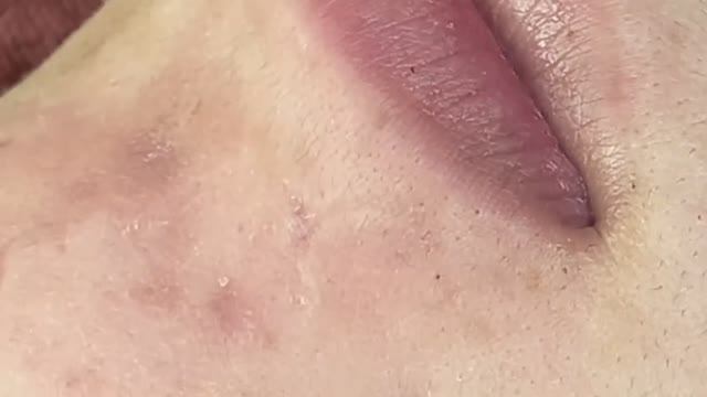 Глубокие подкожные черные точки (комедоны)  #комедоны #проблемнаякожа #уходзалицом