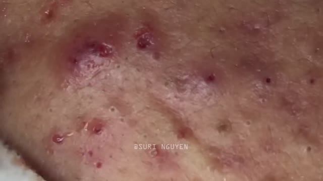 Потрясающее удаление воспаленных черных точек. Часть 4 Серия Suri_1