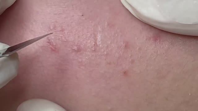 Лечение акне на чувствительной коже. #лечениеакне #чувствительнаякожа #уходзакожей