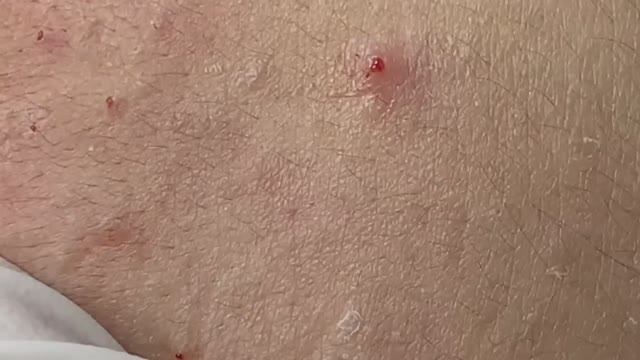 Акне на коже девушки #акне #постакне #механическаячистка