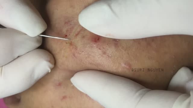 Профессиональное удаление прыщей, черных и белых точек