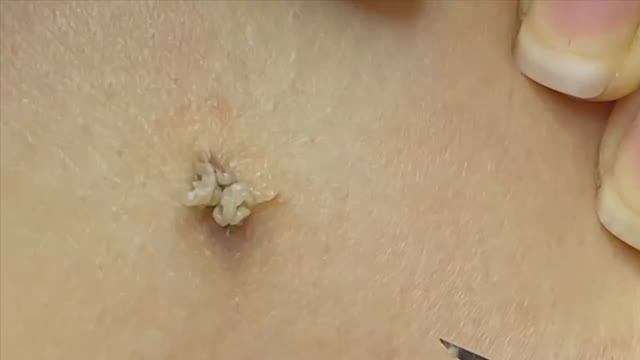 Атероматозная киста (киста сальной железы) на спине