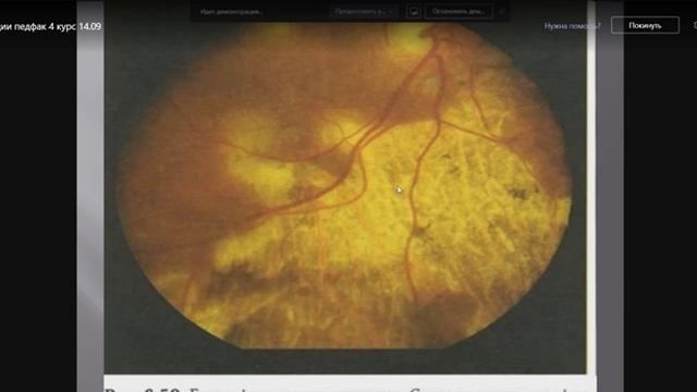 5 Лекция ЗАБОЛЕВАНИЯ СОСУДИСТОЙ и СЕТЧАТОЙ ОБОЛОЧЕК  14_09_2021