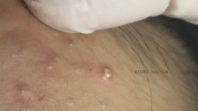 Asmr. Лечим черные точки на лбу. #черныеточки #чисткалица