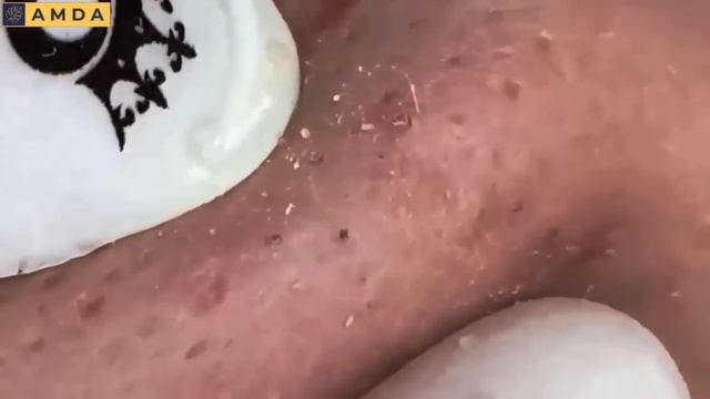 Лечение закрытых комедонов. Расслаблющее видео.