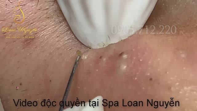 Удаление черных точек и огромных подкожных комедонов 6-летней давности