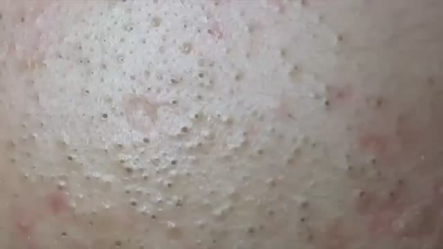 Множественные черные точки на лбу - Удаление комедонов