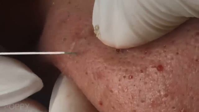 Самое удовлетворяющее удаление комедонов и акне