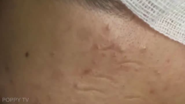 Топ видео: Выдавливание прыщей и чёрных точек  #черныеточки