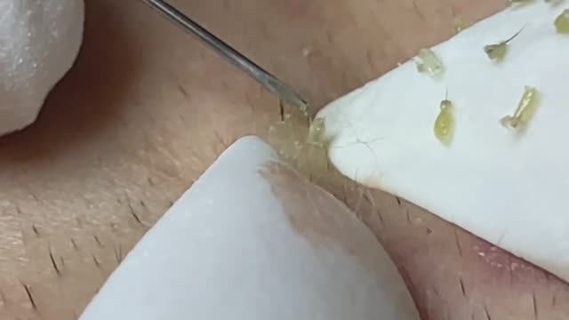 Relax Acne 012 • АСМР • Loan Nguyen collection