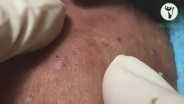 Профессиональное лечение черных точек. #черныеточки #лечениеакне #чисткалица