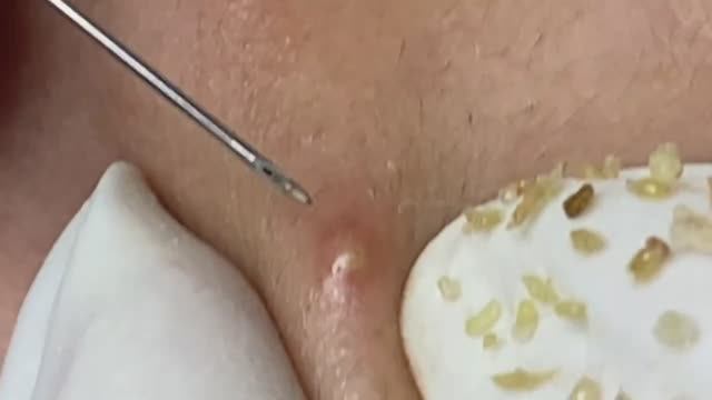 Relax Acne 011 • АСМР • Loan Nguyen collection