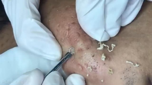 Выдавливание больших черных точек на щеках. ASMR