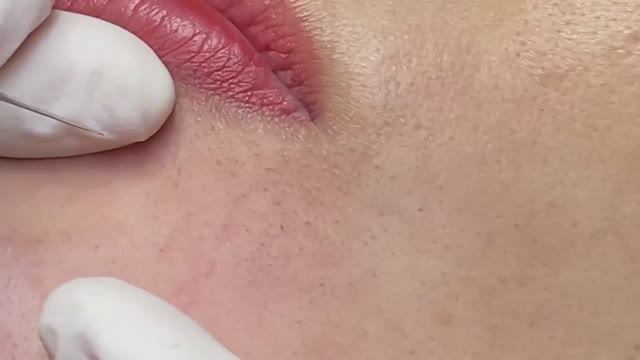 Лечение черных точек и белых угрей: эффективный метод